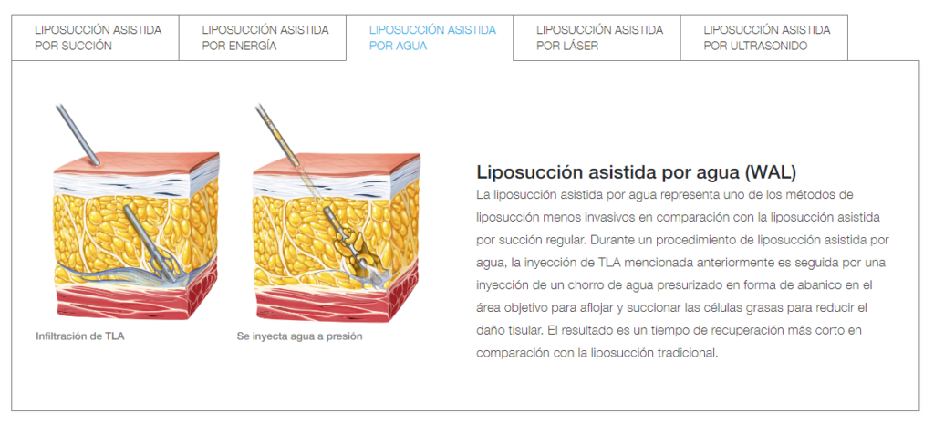 Vibrasat Pro · Power-Assisted Liposuction - Surgest Medical